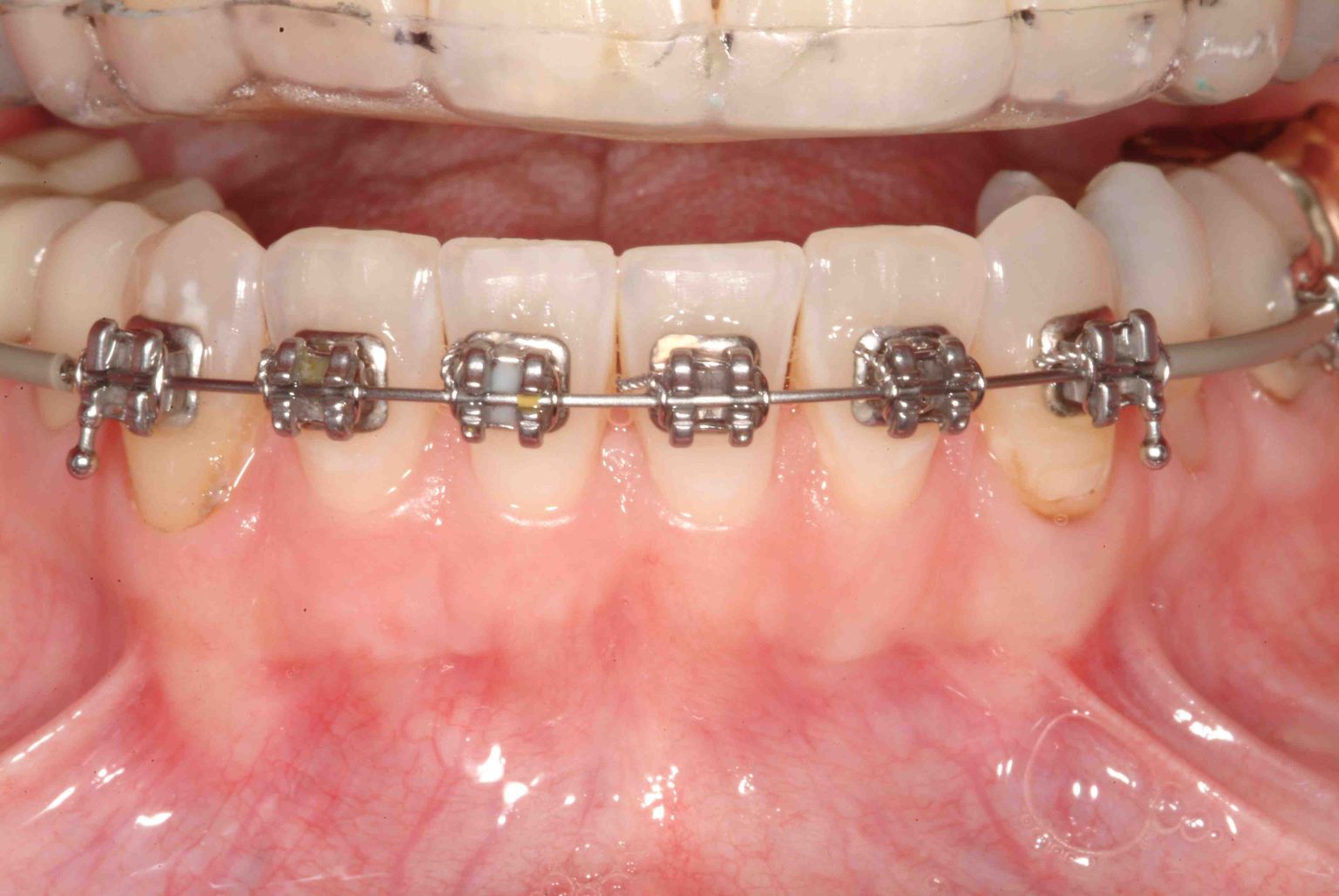 Retention & Orthodontic Treatment - The Pankey Institute