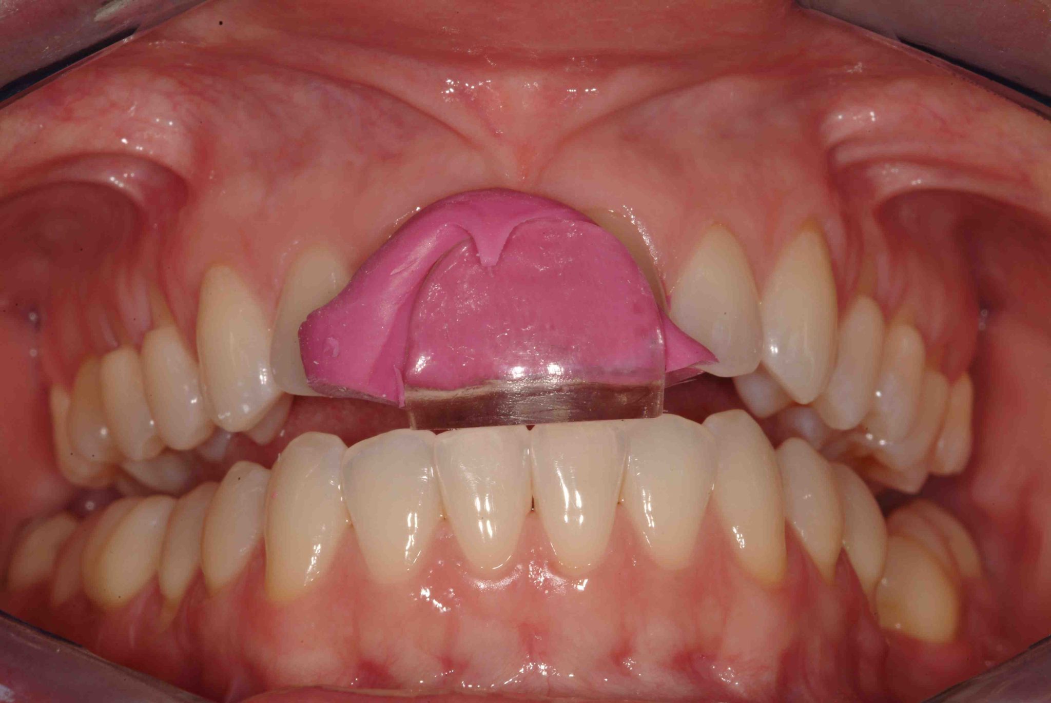 Pankey Bite Stop Centric Relation Record - The Pankey Institute