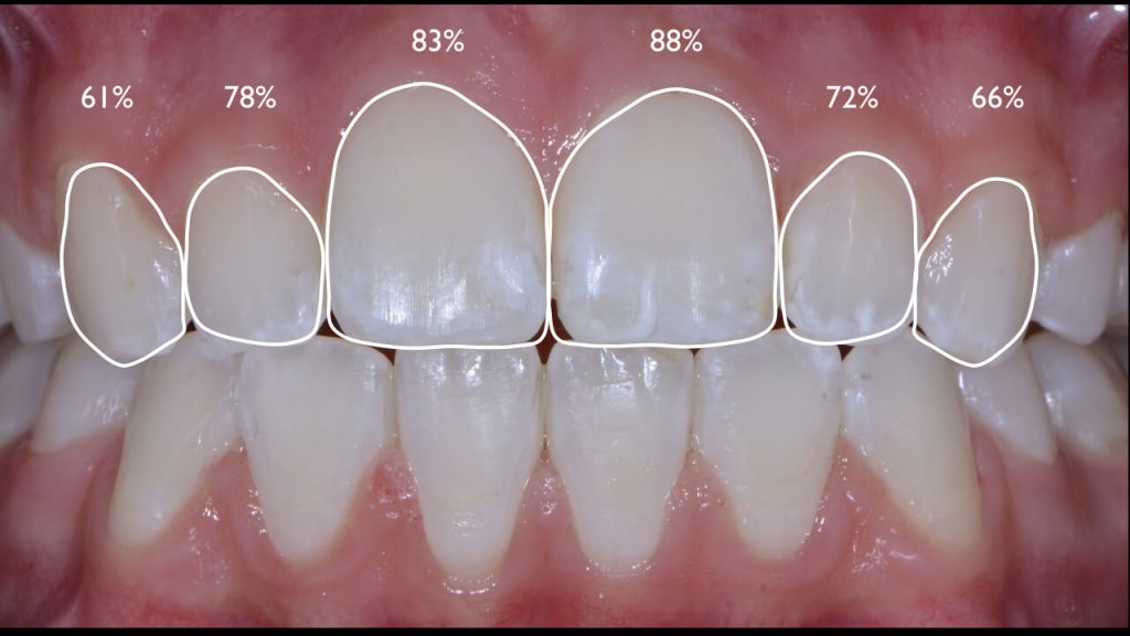 Tooth Proportion Aesthetic Ratio - The Pankey Institute