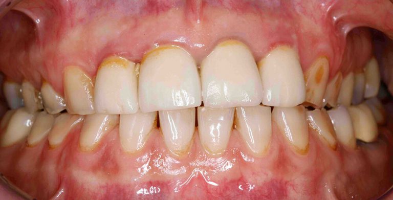 Occlusal Wear Part 2: What is causing the wear? - The Pankey Institute