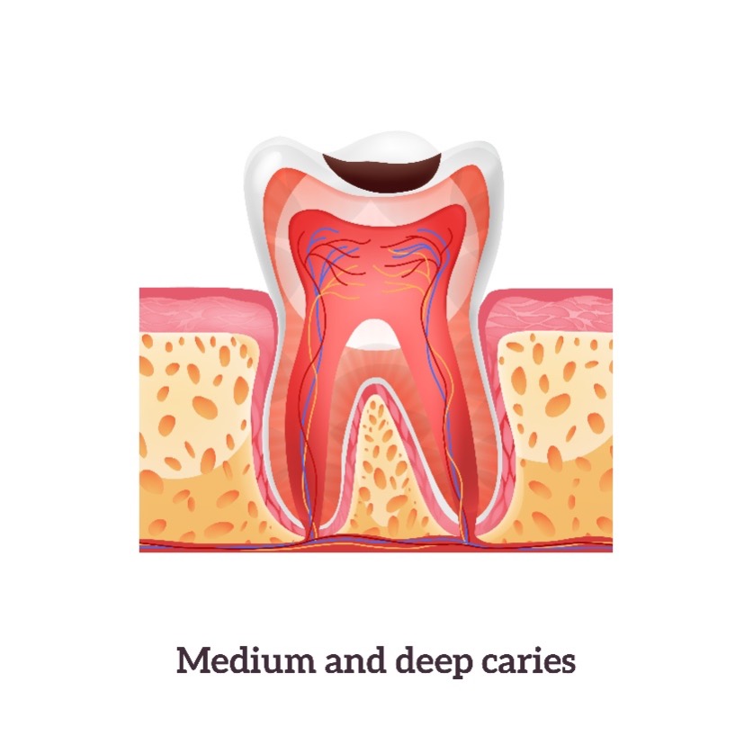 Pulp Capping: Avoiding Root Canals with Vital Pulp Therapy - The Pankey ...